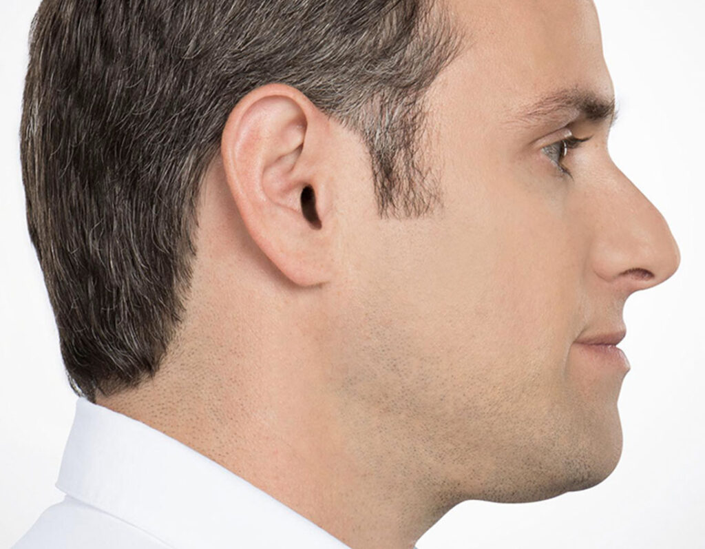 Double Chin - The Aesthetic Lounge