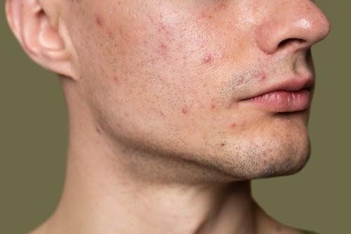 Most Common Types of Acne Scars and Their Causes - The Aesthetic Lounge