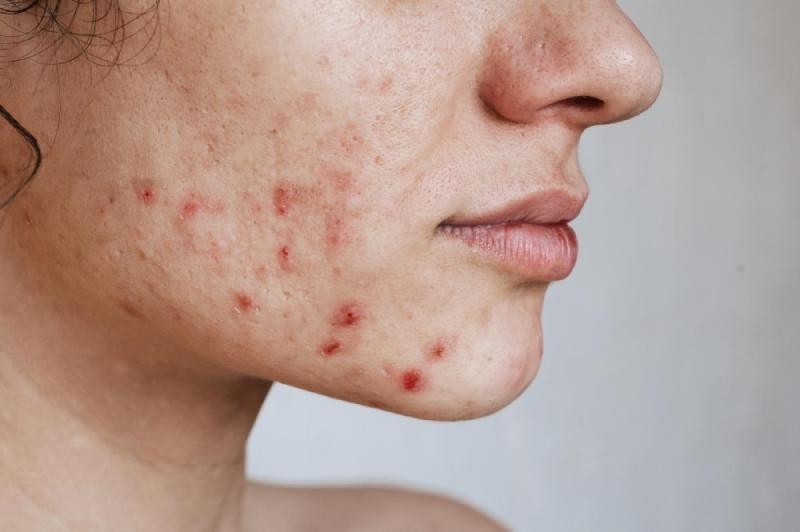 Most Common Types of Acne Scars and Their Causes - The Aesthetic Lounge